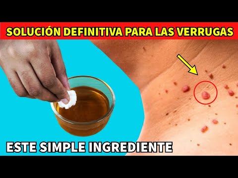 Este Simple ingredientes es capaz de eliminar las Verrugas muy rápido ...